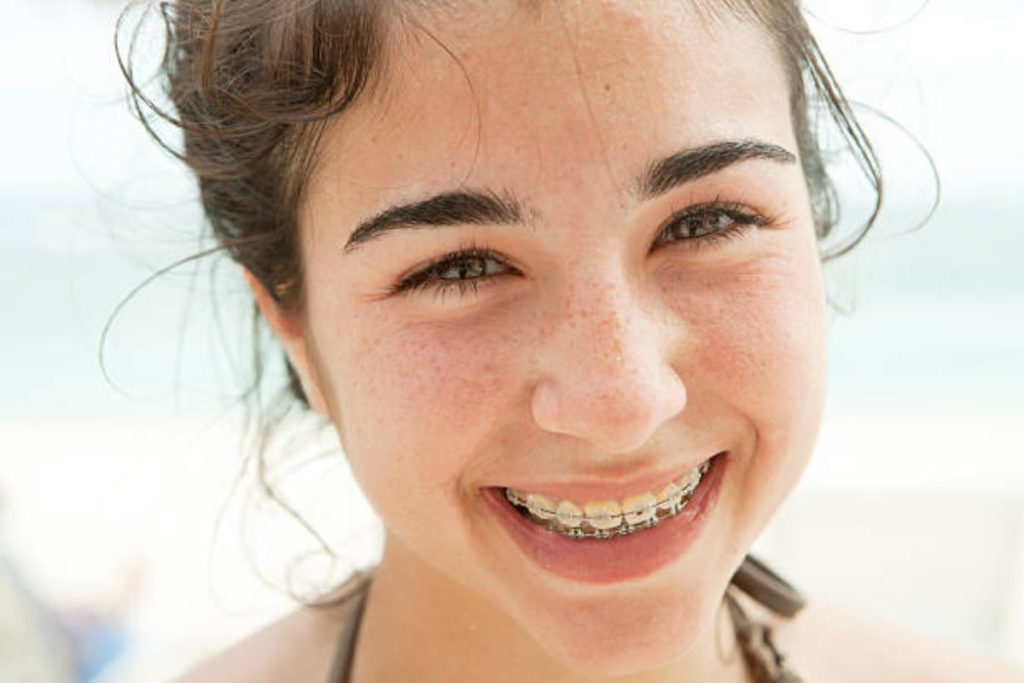 When Do I Get My Braces Off? Dillehay Orthodontics